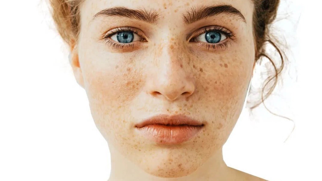 Get Rid of Your Brown Spots with Laser Intense Pulsed Light (IPL ...